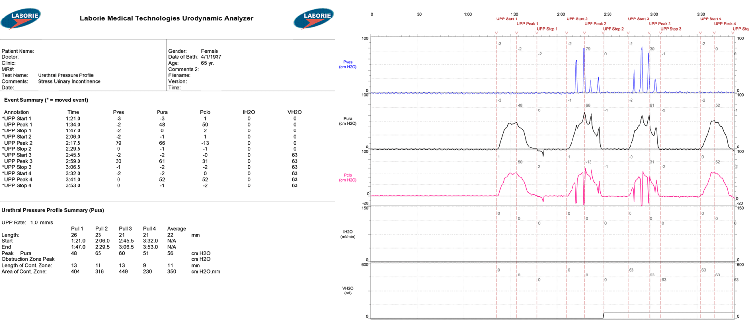 Laborie Delphis — Примеры исследований — Урофлоуметр Поток-К